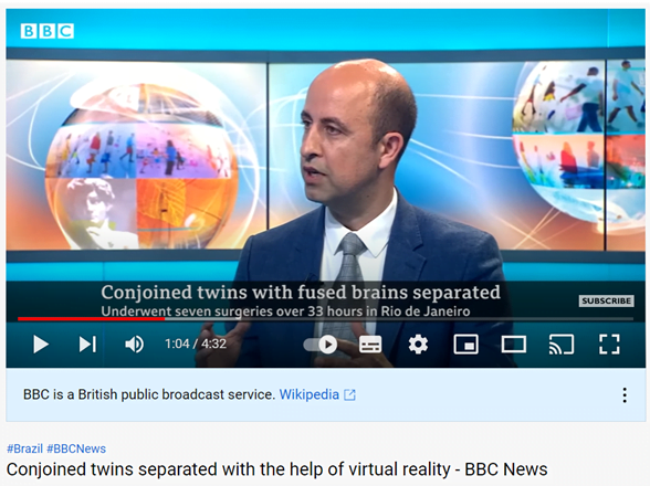 Conjoined twins separated with the help of virtual reality - BBC News ...